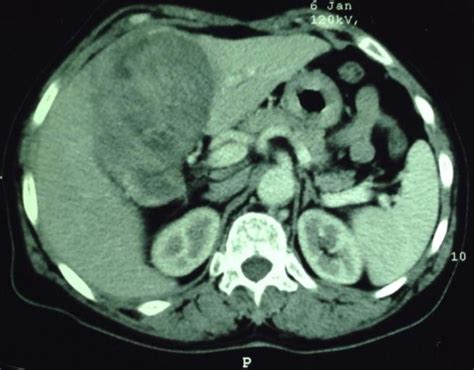 Abdominal Ct Heterogeneous Hepatic Masse Misdiagnosed As Gist Download Scientific Diagram