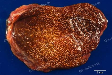 Cholesterolosis Clinical Features