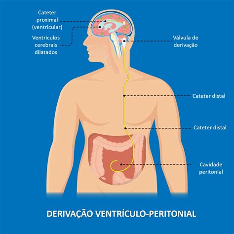 Tratamento De Hidrocefalia Antes E Depois