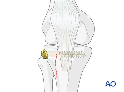 Mio Percutaneous Lag Screws For Partial Articular Fracture Split