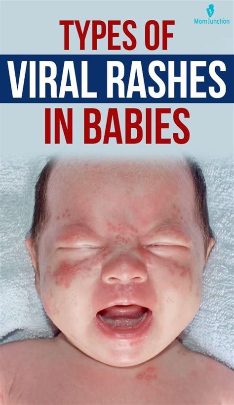Types Of Rashes Artofit
