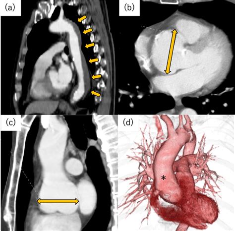 Uncomplicated Stanford Type B Debakey Type Iiib Acute Aortic
