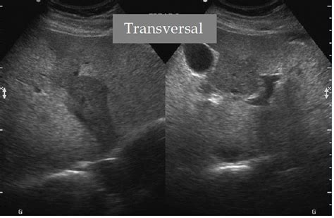 Ultrasonic Imaging In Liver Disease From Bench To Bedside Intechopen