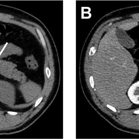 The Ectopic Pancreas In The Left Adrenal Gland There Was A