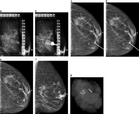 Magnetic Seed Lumpectomy At Harrison Trethowan Blog