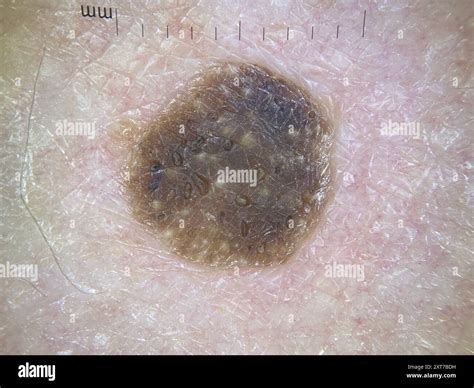 Not To Be Used For Advertising Or In A Defamatory Context Dermatoscope Image Of A Seborrheic