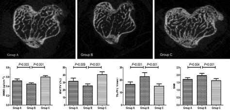 Histomorphometric Parameters Of Subchondral Bone By Microcomputed
