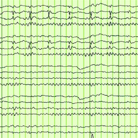 Hypnagogic Hypersynchrony A Normal Eeg Variant 42 Download Scientific Diagram Hypnagogic Hypersynchrony A Normal Eeg Variant 42 Download Scientific Diagram
