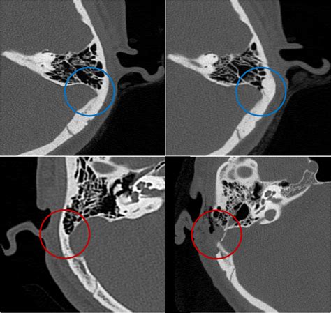 Tailored Re‐roofing Technique For Pulsatile Tinnitus Caused By Sigmoid