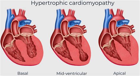 Invasive Management Of Hypertrophic Cardiomyopathy With Clinically