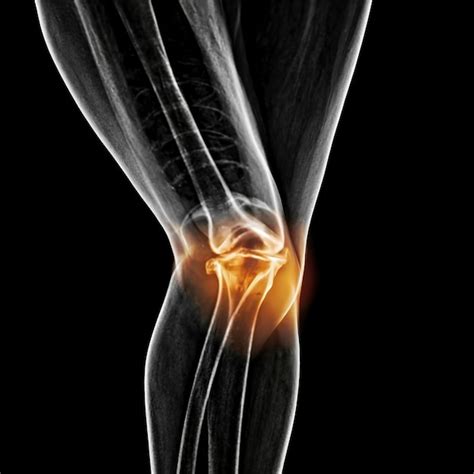 Osteoarthrite X Ray Du Genou Gauche Ap Lavant Et Larrière Du Genou