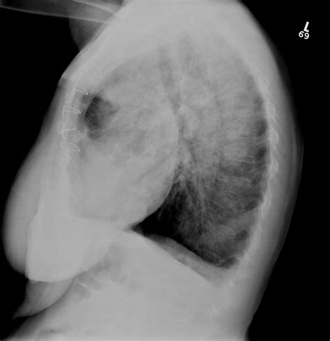 Post Gad Metastatic Calcification