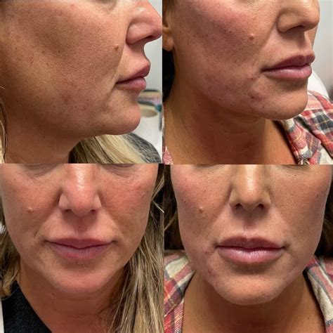 Mint Pdo Threads Inject Your Beauty