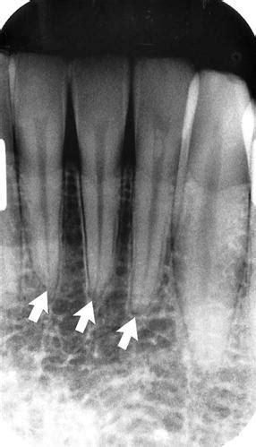 Nutrient Canal Dental Radiograph