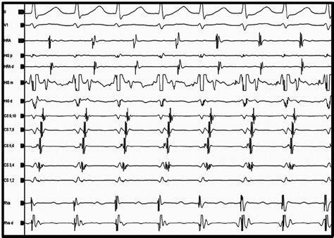 Eccentric Activation During Tachycardia In A Patient With Left Free Download Scientific Diagram