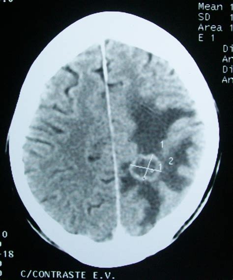 Cat Scan Brain Tumor