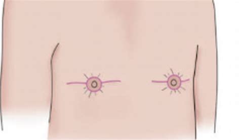 Mastectomia Rafael Vaquinhas Online