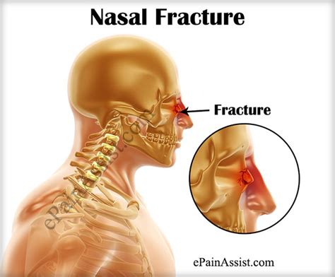 Signs Your Nose Is Broken Suspected Broken Nose Tvhg