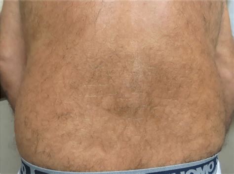 Secondary Syphilis Presenting As Leucoderma Syphiliticum Case Report And Review Abstract