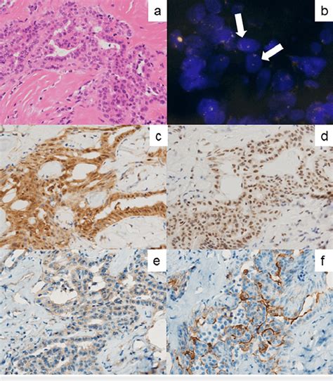 Molecular And Immunohistochemical Analysis For P16ink4a P16 And