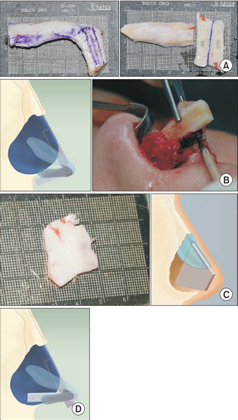 Figure 1 From A New Classification System Of Nasal Contractures