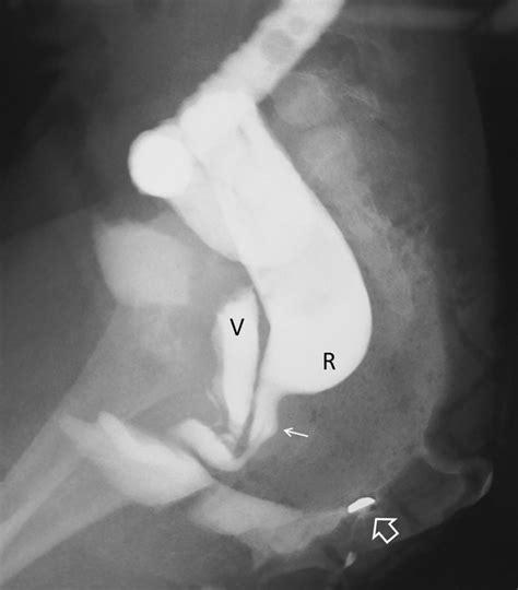 The High Pressure Colostogram Showing A Long And Narrow Fistula Tract