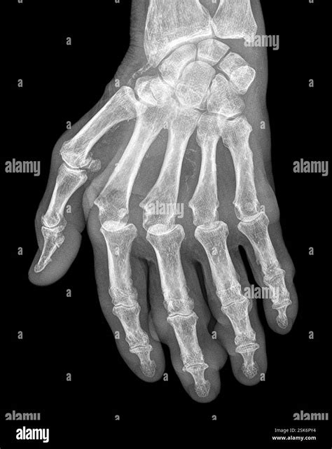 Arthritic Hand X Ray Of A Section Through The Left Hand Of A 77 Year
