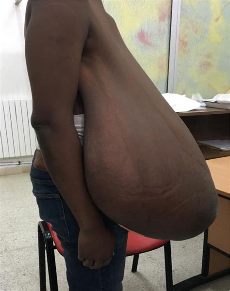 Figure 1 From Extreme Idiopathic Gigantomastia Semantic Scholar
