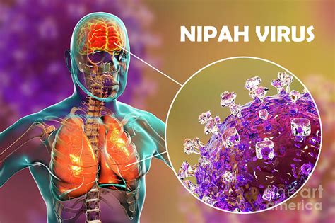 Encephalitis Caused By Nipah Viruses 2 Photograph By Kateryna Kon Science Photo Library Fine