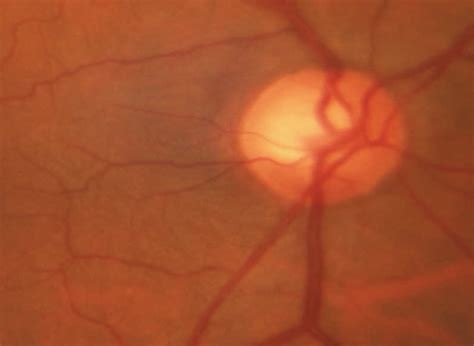 Joag Misdiagnosed As Amblyopia