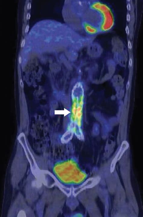 The Roles Of Open And Endovascular Repair In Aortic Infection