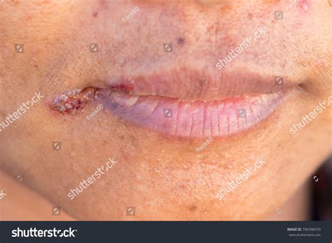 15 Cheilosis And Stomatitis Royalty Free Photos And Stock Images