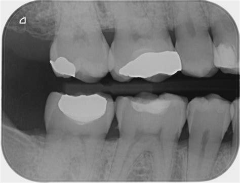Bitewing Xrays 4 Buyxraysonline Bitewing Xrays 4 Buyxraysonline