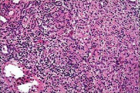 Tubulo Interstitial Nephropathy 1ppt