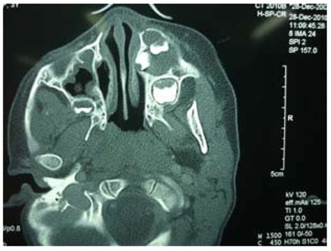 Cect Showing Corticated Cystic Lesion Involving Forming Premolars