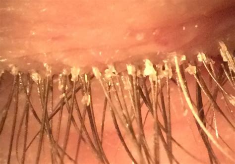Blepharitis And Styes