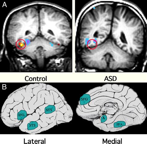 超激安通販 Autism and the Brain Neurophenomenological Interpretation