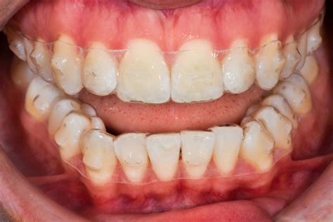 Clear Orthodontic Aligners Dental Office Brussels
