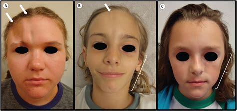 Idiopathic Progressive Hemifacial Atrophy Clinical Tree