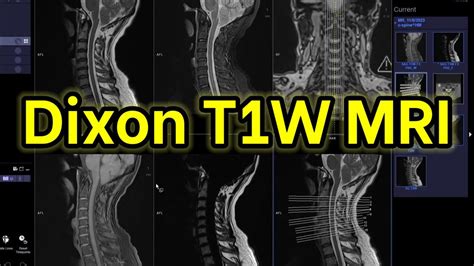 Kinh Nghiệm Chụp Xung Dixon Mri Youtube