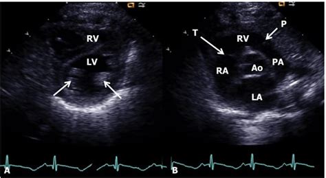 Neonatal Echo