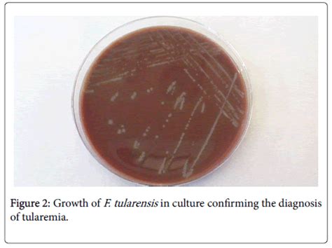 Tularemia A Case Report Omics International