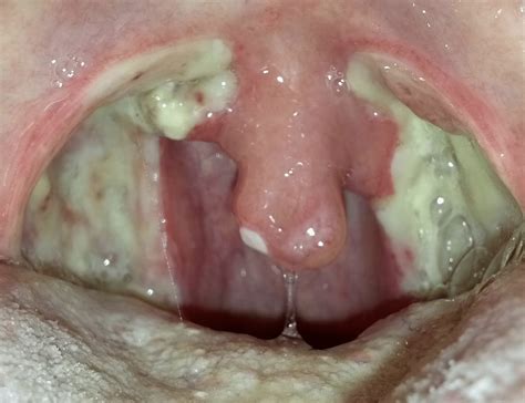 Tonsillitis Quinsy Abscess Antibiotics Teachmesurgery