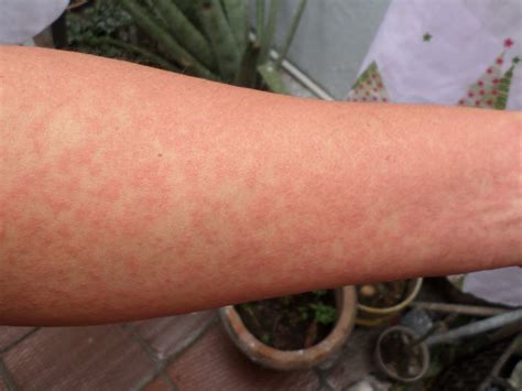 Viral Conditions To Consider For Morbilliform Eruptions In Pediatric