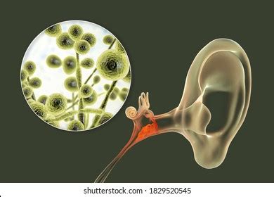 Otomycosis Candida