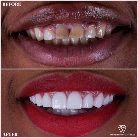 Grey Dental Crown Roots Teethwhiteningproduct