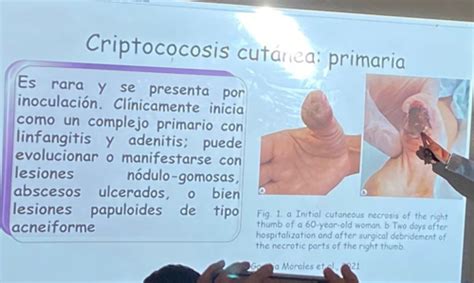 Cryptococosis Flashcards Quizlet