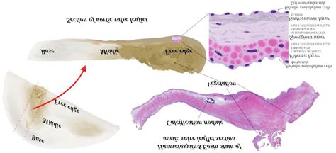 Scheme Of Infective Endocarditis Affected Native Aortic Valve That