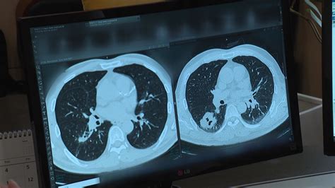 폐암 수술이면 끝전이 피할 후속 항암치료 나서야