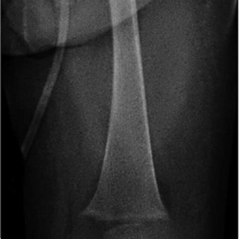 Mild To Moderate Rickets Of The Distal Femur Download Scientific Diagram